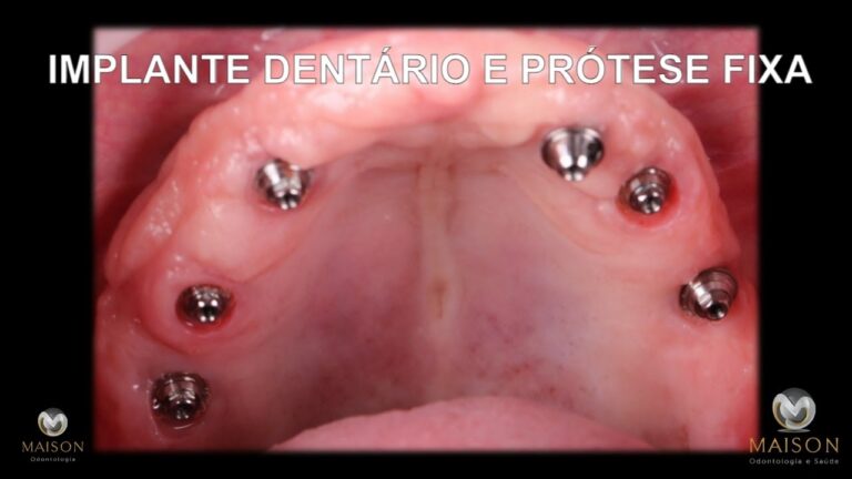 Implantes Dentários: Tudo o que Você Precisa Saber | Actualizado enero 2026